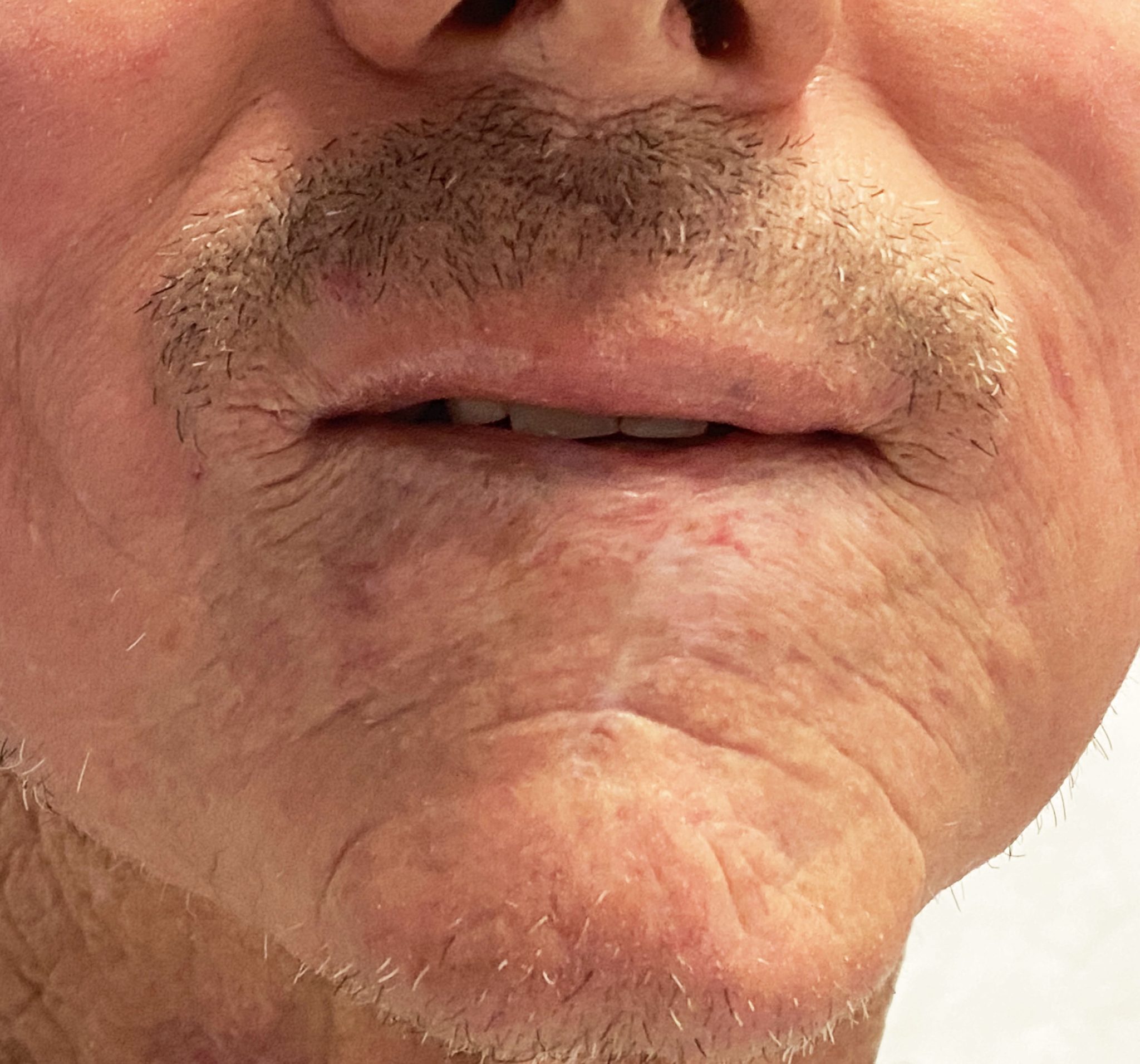 Plastic Surgery Case Study - Mouth Widening and Chin Fat Grafting in ...