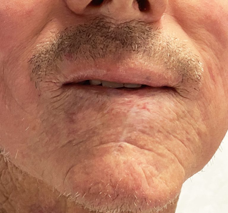 Plastic Surgery Case Study - Mouth Widening and Chin Fat Grafting in ...