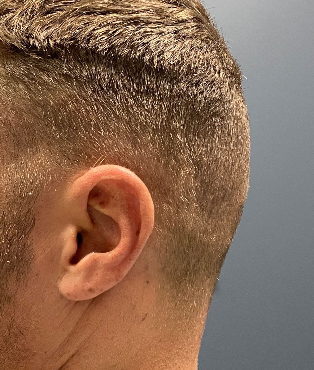 Plastic Surgery Case Study - Occipital Skull Reduction Years After ...