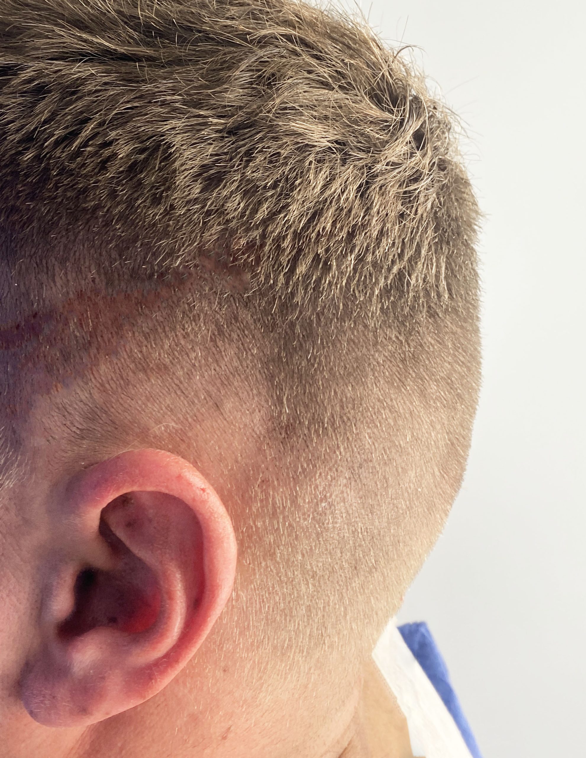 Plastic Surgery Case Study - Occipital Skull Reduction Years After ...