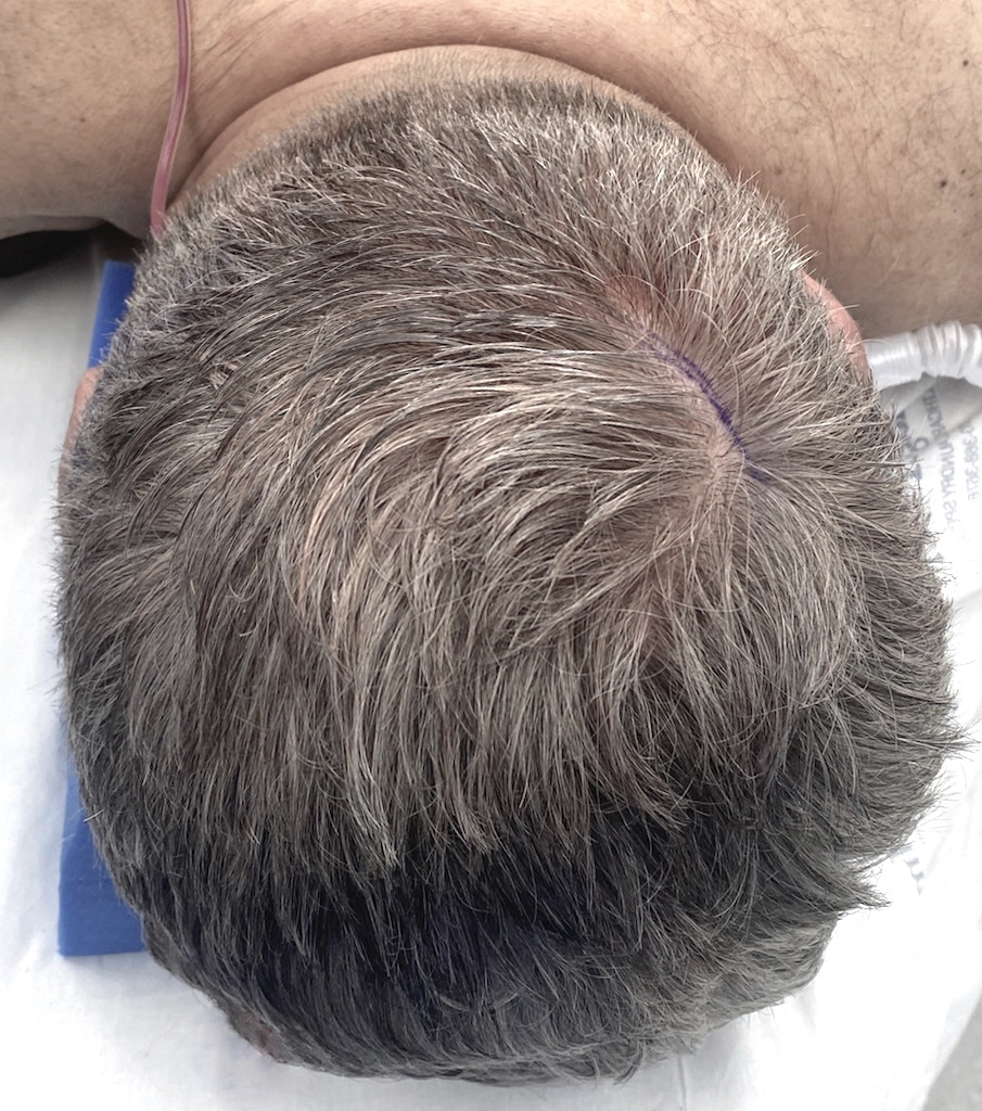 Plastic Surgery Case Study - Custom Back of Head Skull Implant for ...