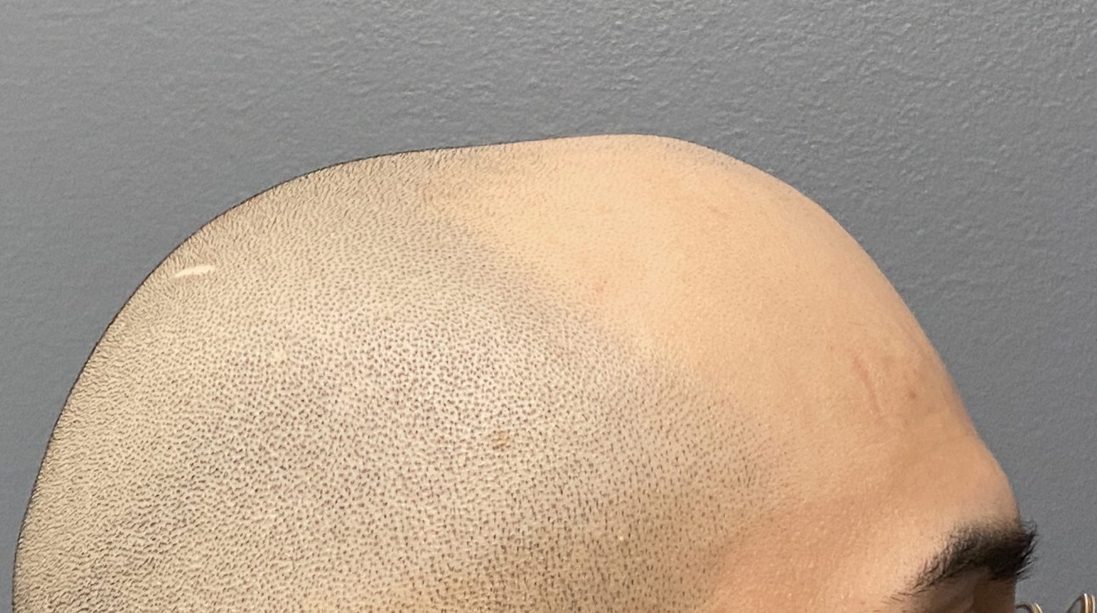 Plastic Surgery Case Study - Surgical Technique for Anterior Sagittal ...