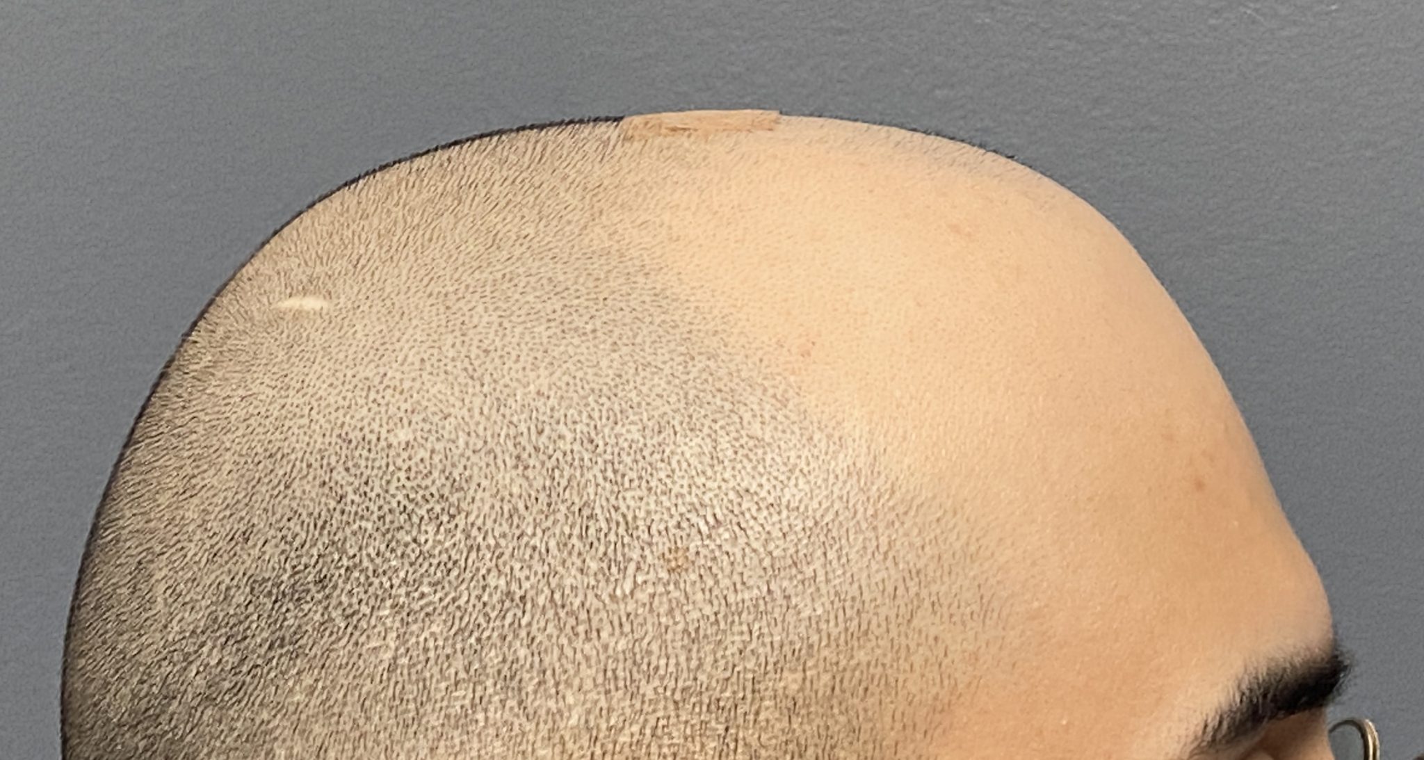 Plastic Surgery Case Study - Surgical Technique for Anterior Sagittal ...