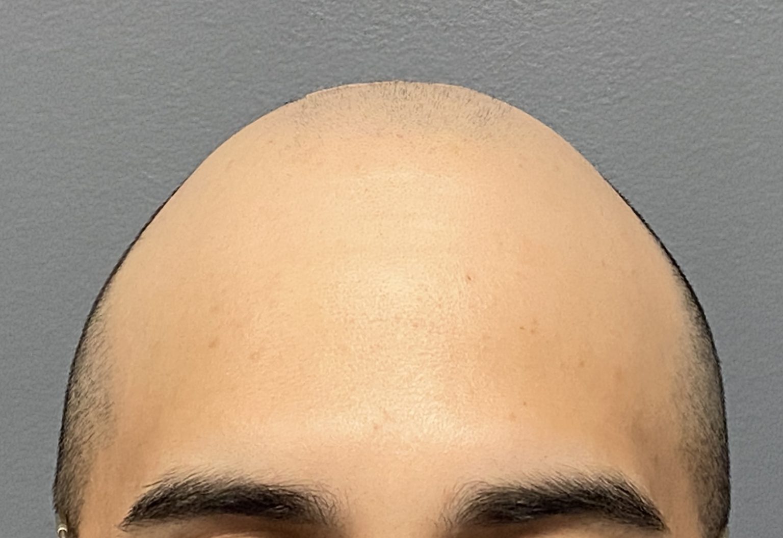 Plastic Surgery Case Study - Surgical Technique for Anterior Sagittal ...