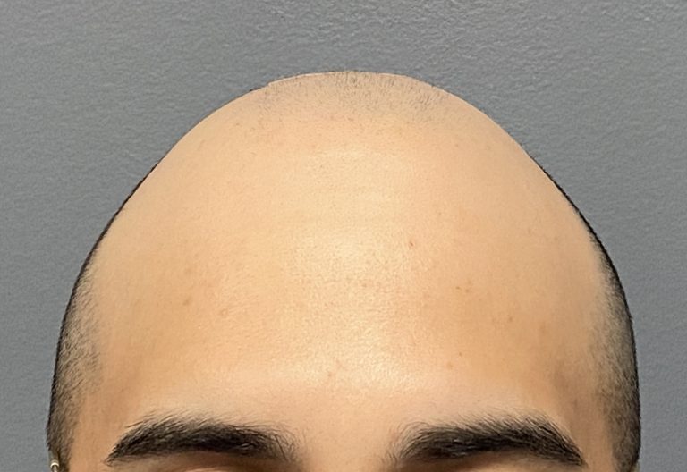 Plastic Surgery Case Study - Surgical Technique for Anterior Sagittal ...