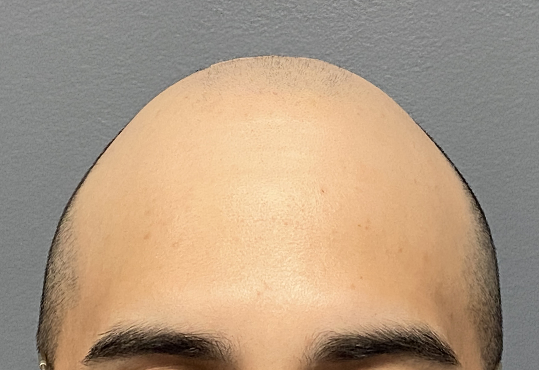 Plastic Surgery Case Study - Surgical Technique for Anterior Sagittal ...