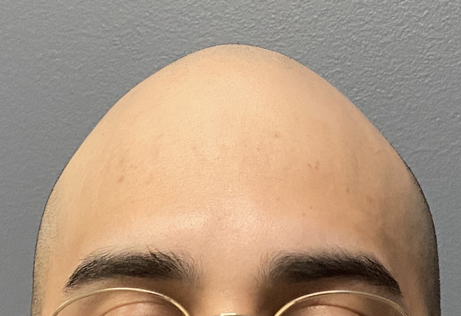 Plastic Surgery Case Study - Surgical Technique for Anterior Sagittal ...