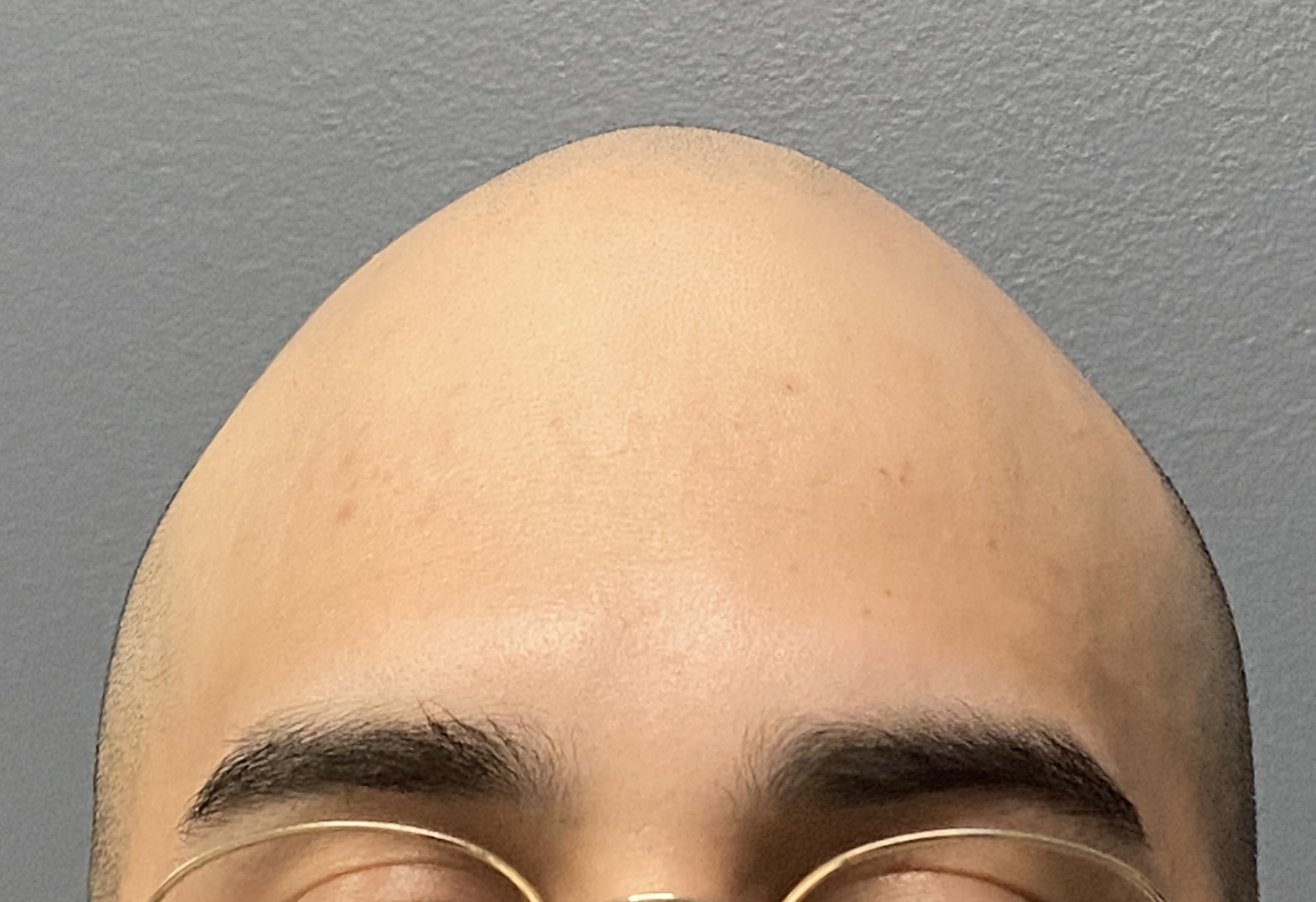 Plastic Surgery Case Study - Surgical Technique for Anterior Sagittal ...