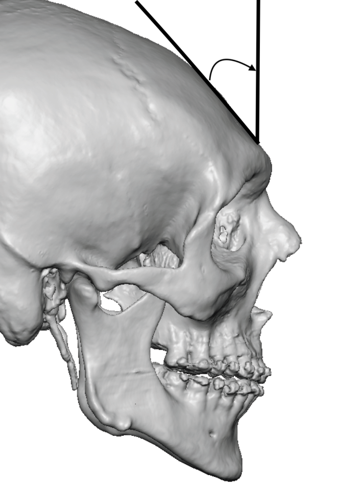 male sloped forehead amngle 3D CT scan Dr Barry Eppley copy - Explore ...