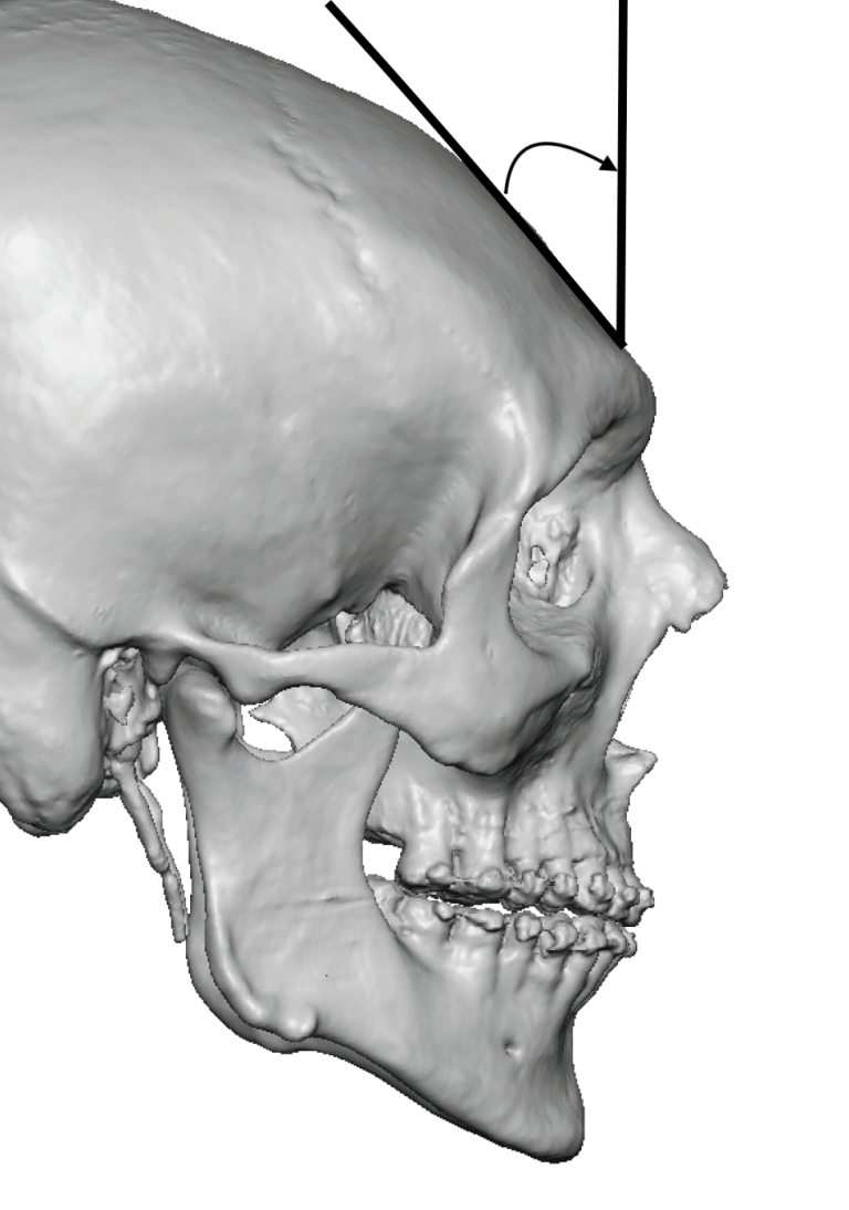 male sloped forehead amngle 3D CT scan Dr Barry Eppley copy - Explore ...