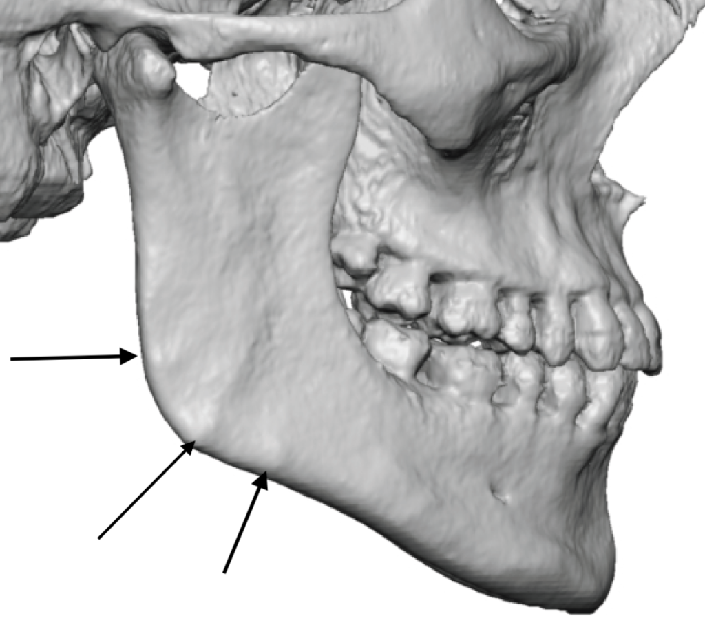Plastic Surgery Case Study - Composite Soft Tissue Jaw Angles Implants ...