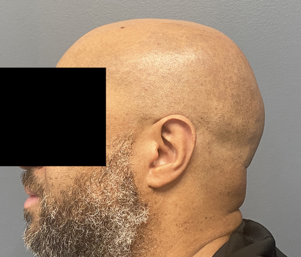 Plastic Surgery Case Study - Male Occipital Bun Reduction by a High ...