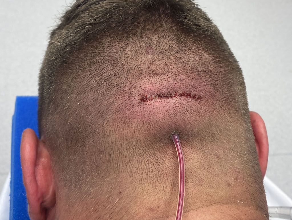 Plastic Surgery Case Study - Occipital Skull Reduction Years After ...