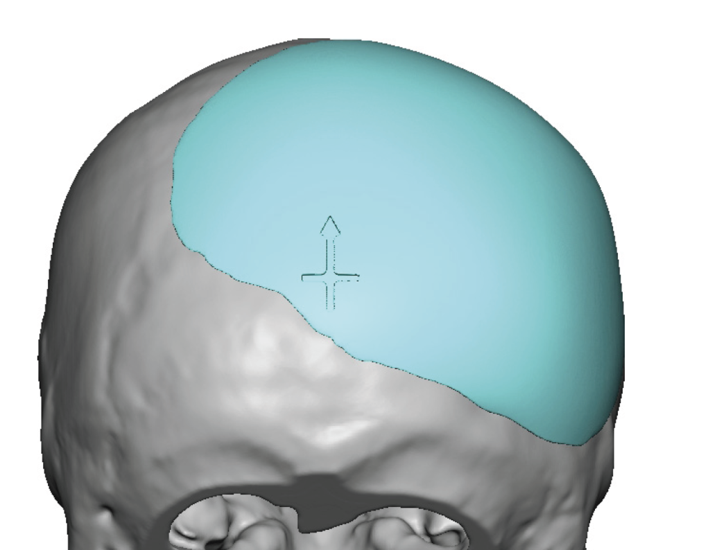 Plastic Surgery Case Study - Custom Back of Head Skull Implant for ...