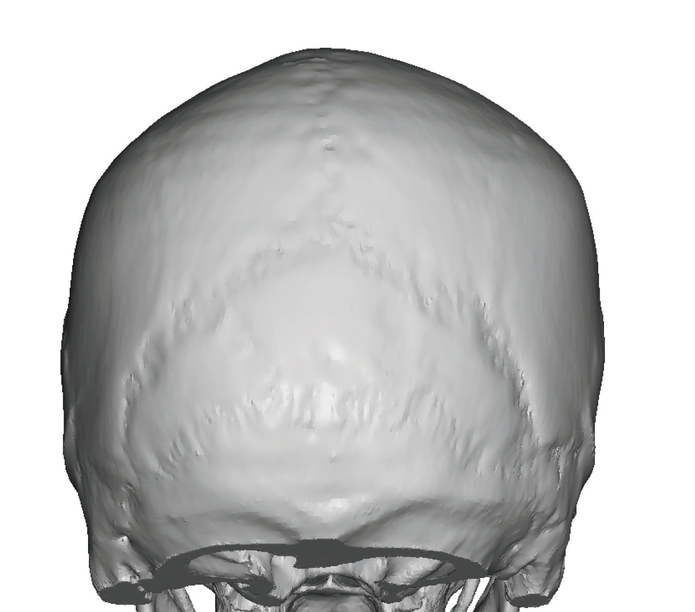 Plastic Surgery Case Study - Custom Back of Head Skull Implant for ...