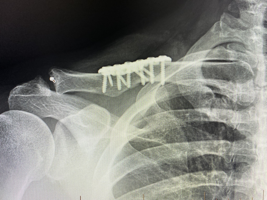 Technical Strategies - Single vs Double Plate Fixation in Clavicle ...