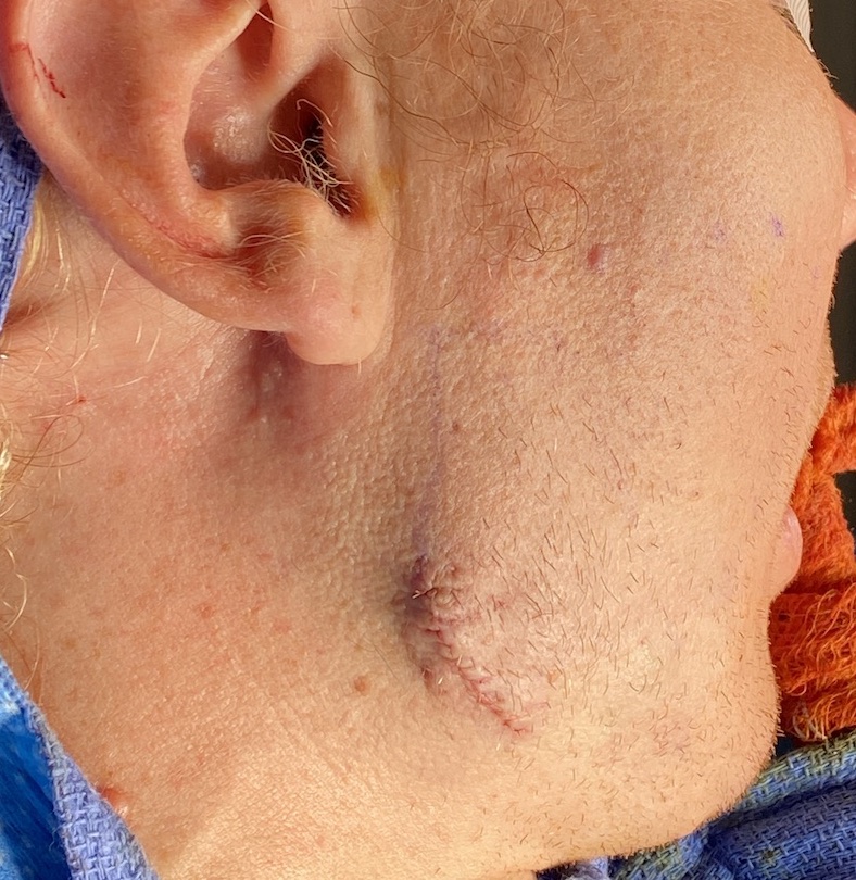 Plastic Surgery Case Study - Composite Soft Tissue Jaw Angles Implants ...