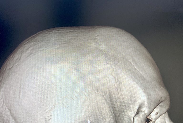 sagittal ridge 3D CT scan Dr Barry Eppley - Explore Plastic Surgery