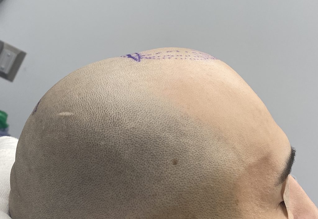 Plastic Surgery Case Study - Surgical Technique for Anterior Sagittal ...