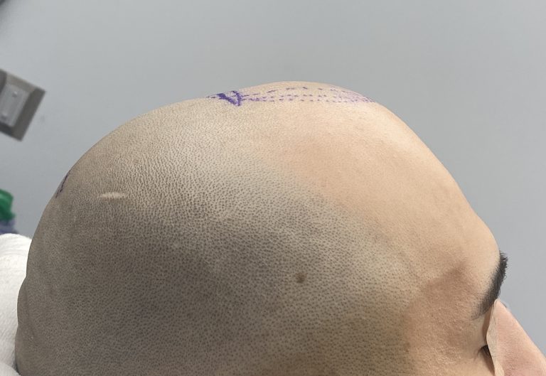 sagittal ridge skull reduction side 1 Dr Barry Eppley - Explore Plastic ...