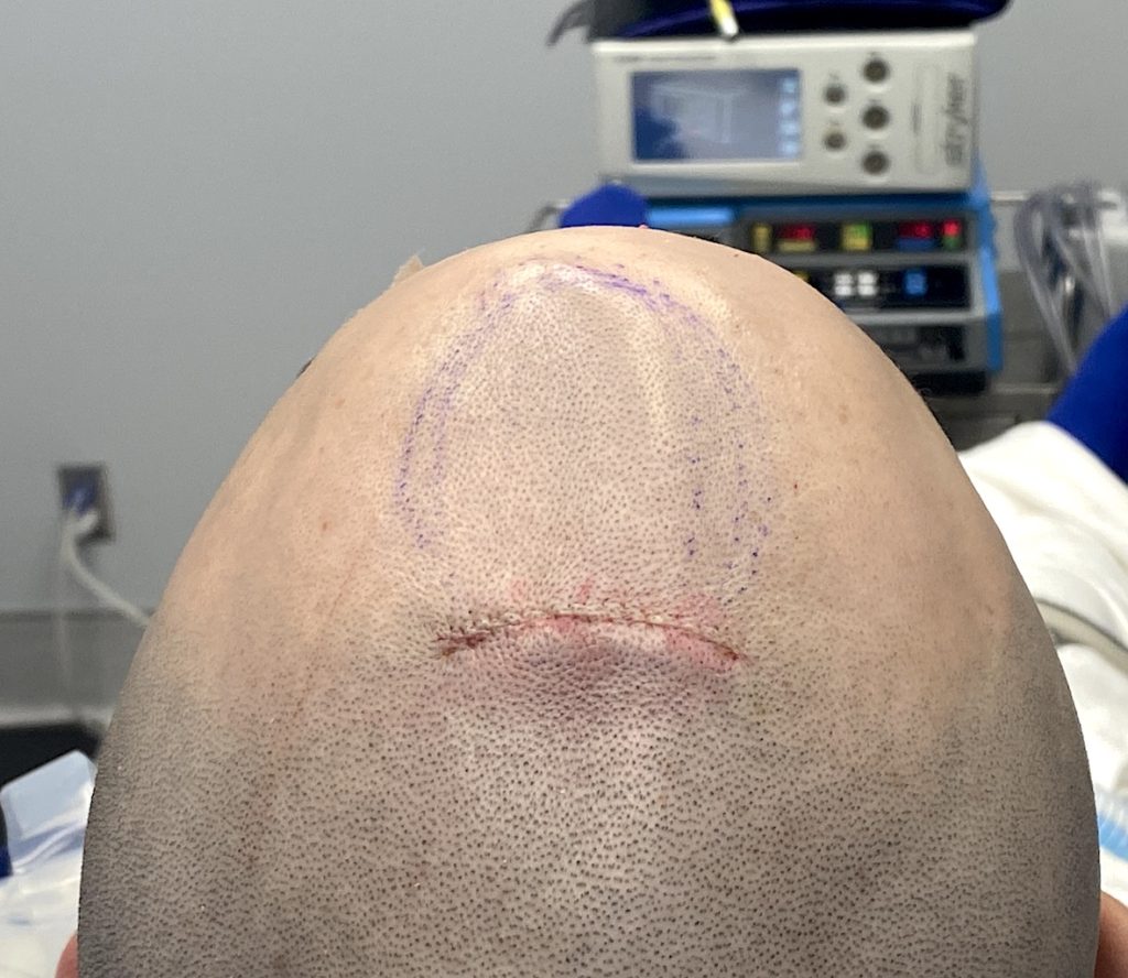 sagittal ridge skull reduction technique 6 Dr Barry Eppley - Explore ...