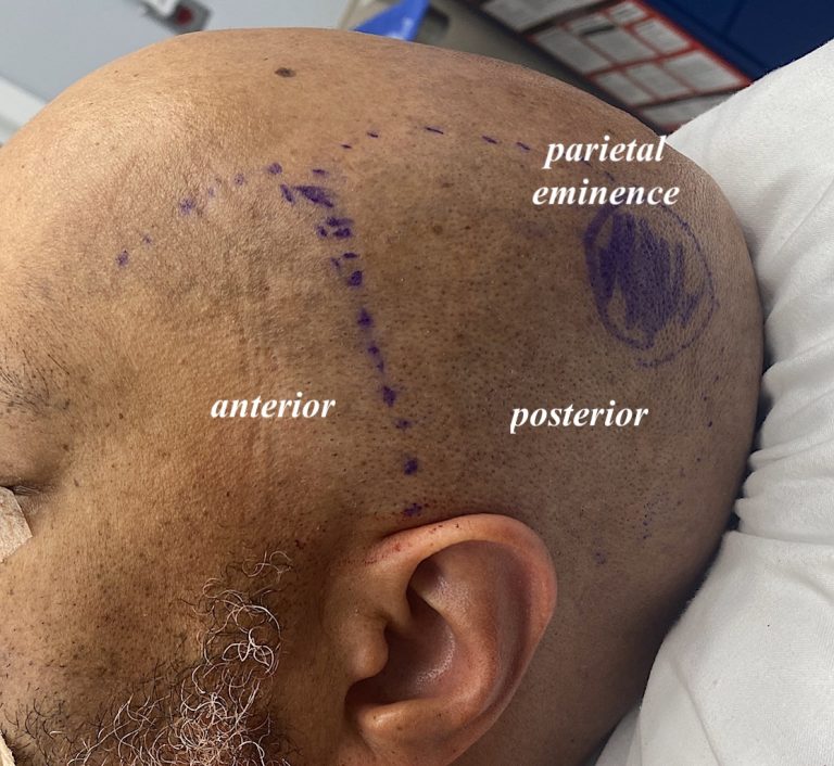 Plastic Surgery Case Study - Head Width Reduction with a Combination ...