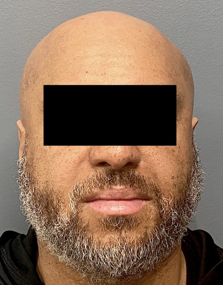 Plastic Surgery Case Study - Head Width Reduction with a Combination ...