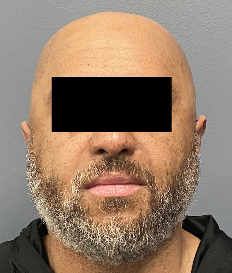 Plastic Surgery Case Study - Head Width Reduction with a Combination ...