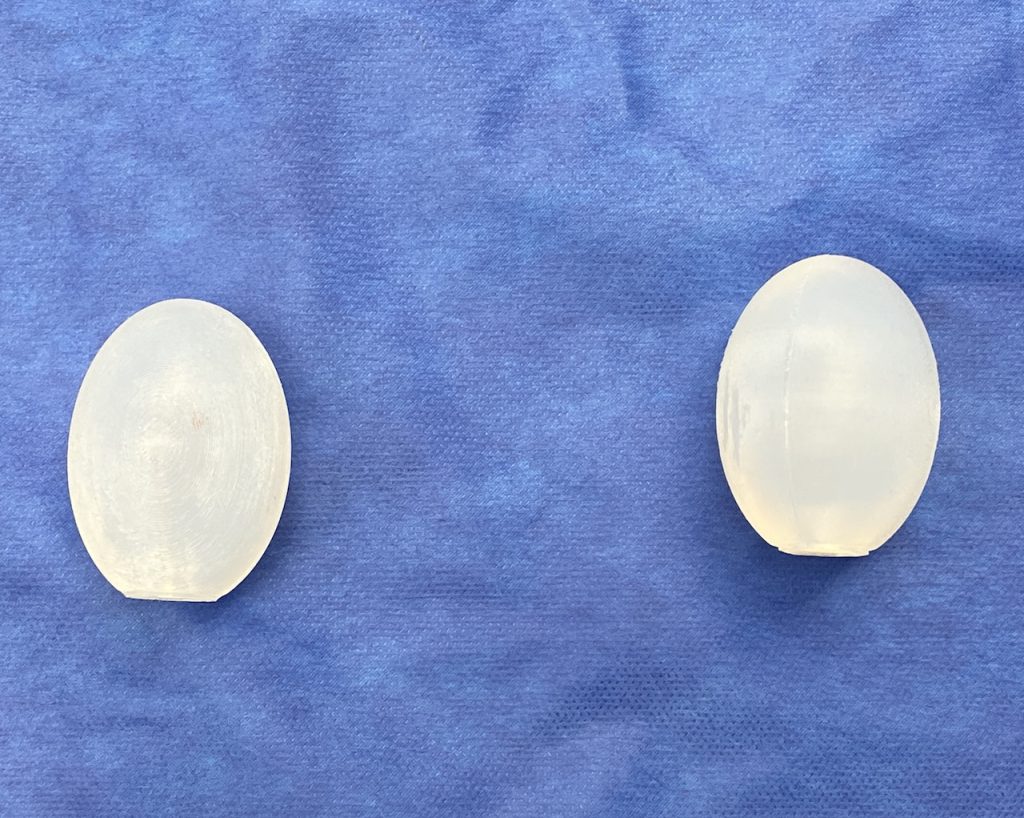 Plastic Surgery Case Study - Custom Wraparound Testicle Implants Based ...