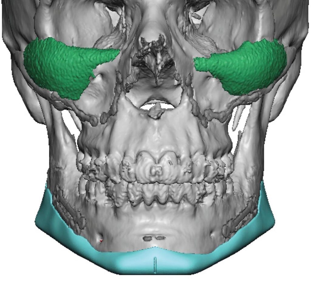 Plastic Surgery Case Study - Custom Jawline Implant Refinement after ...