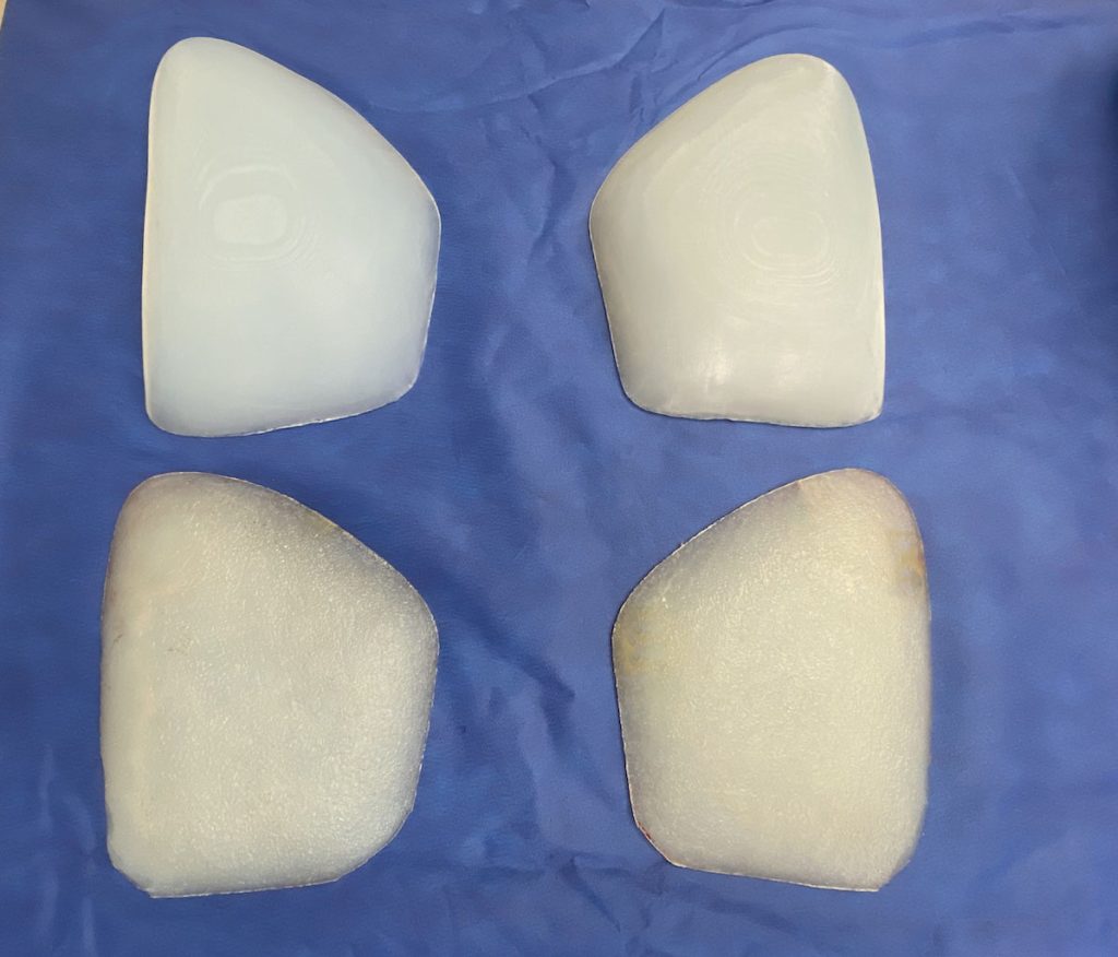 Custom Pectoral Implant Replacements intraop comparison Dr Barry Eppley ...