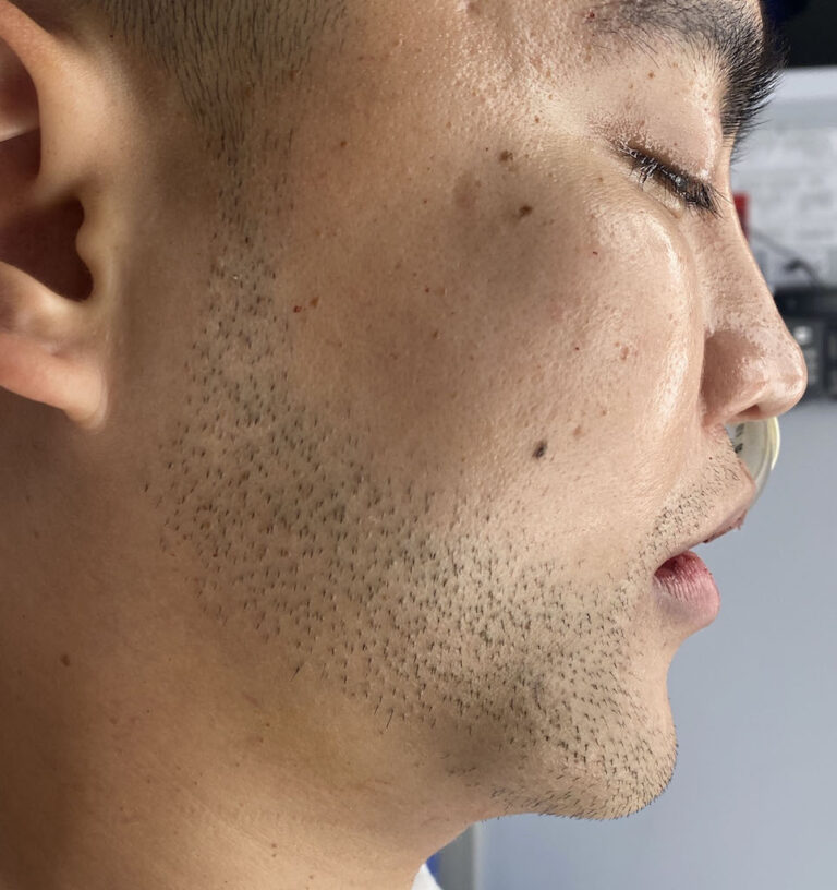 Plastic Surgery Case Study - Reshaping the Short Wide face with ...