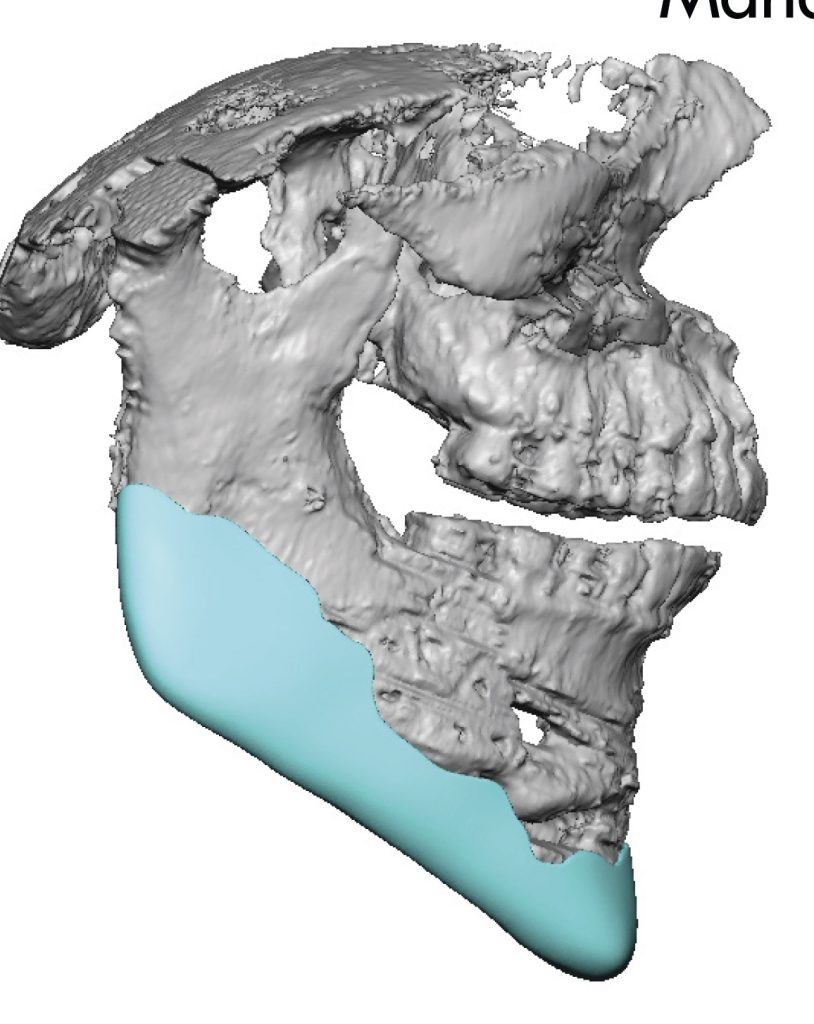 Plastic Surgery Case Study - Custom Jawline Implant after Extreme ...