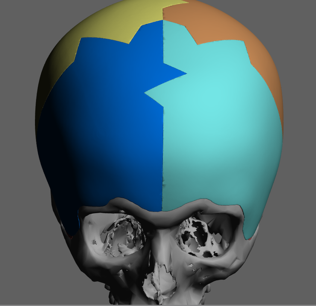 Plastic Surgery Case Study - A Segmentalized Technique for the ...