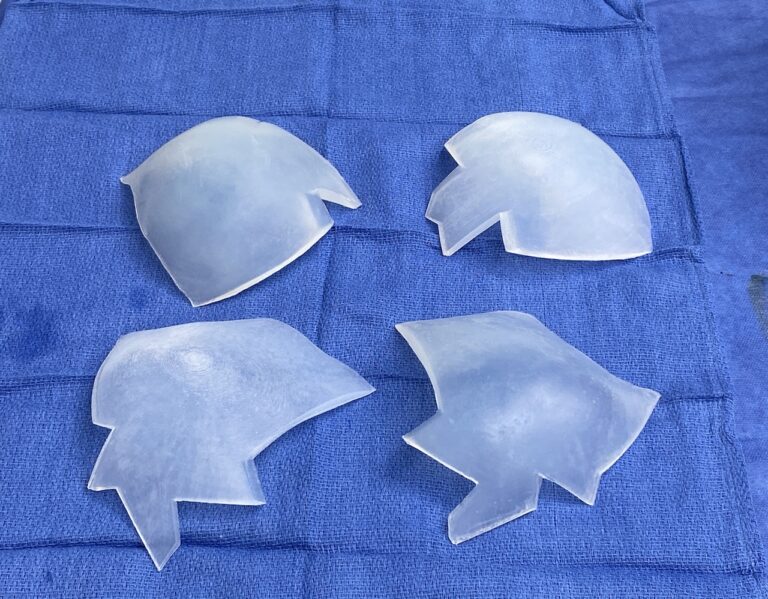 Plastic Surgery Case Study - A Segmentalized Technique for the ...