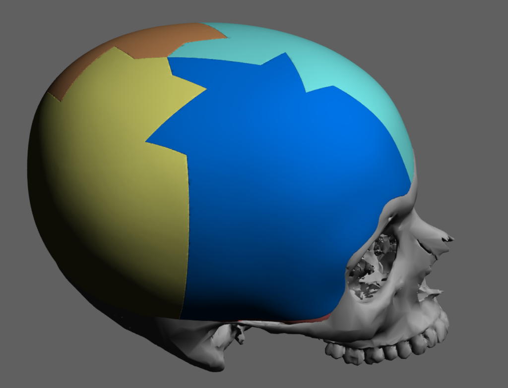 Plastic Surgery Case Study - A Segmentalized Technique for the ...