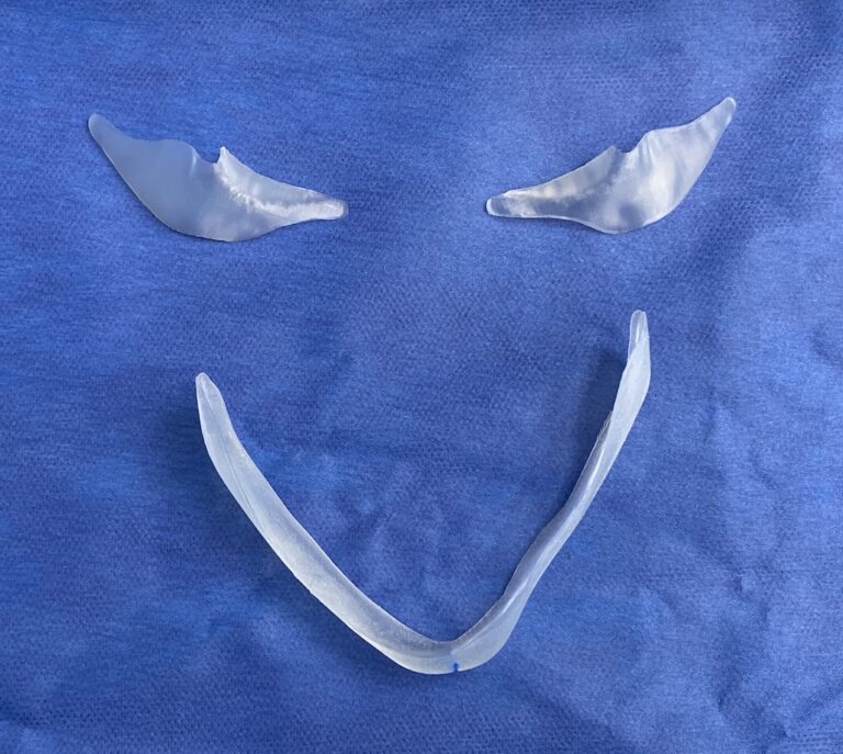 Plastic Surgery Case Study - Custom Female Infraorbital-Malar and ...