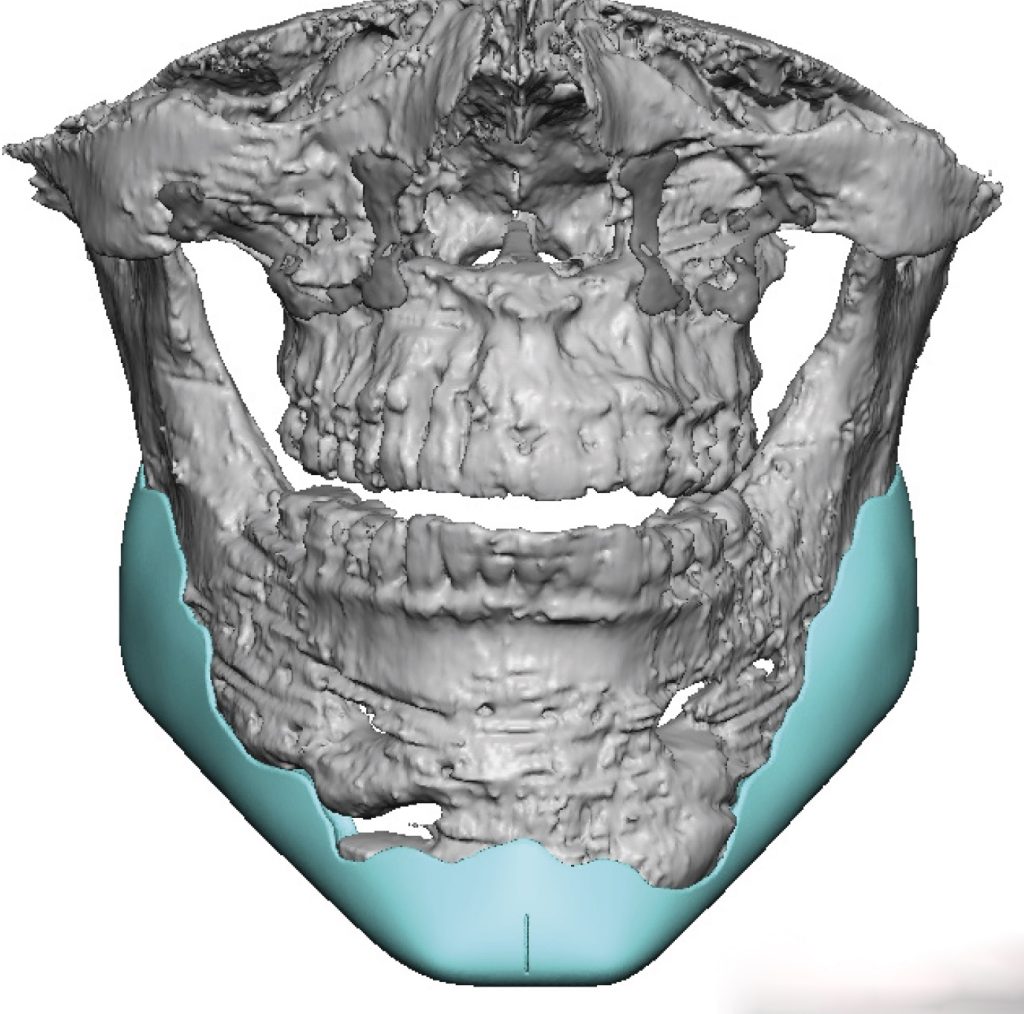Plastic Surgery Case Study - Custom Jawline Implant after Extreme ...