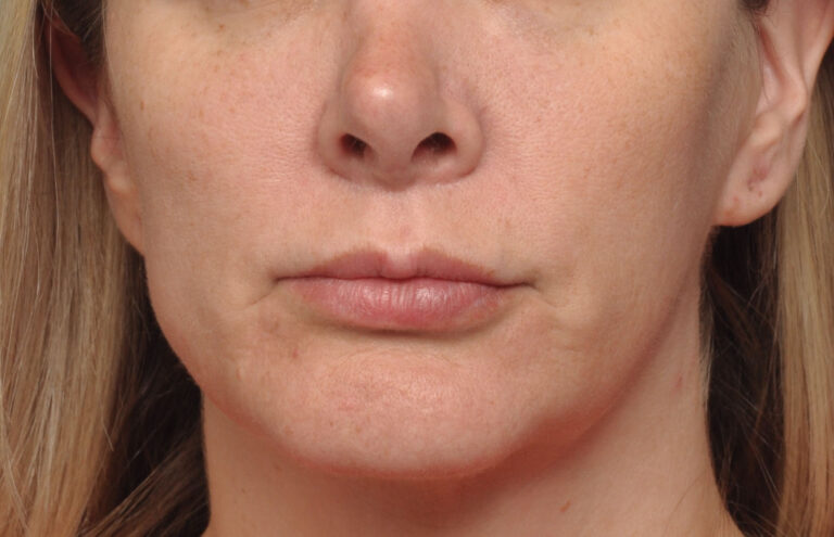 Plastic Surgery Case Study - Custom Female Infraorbital-Malar and ...