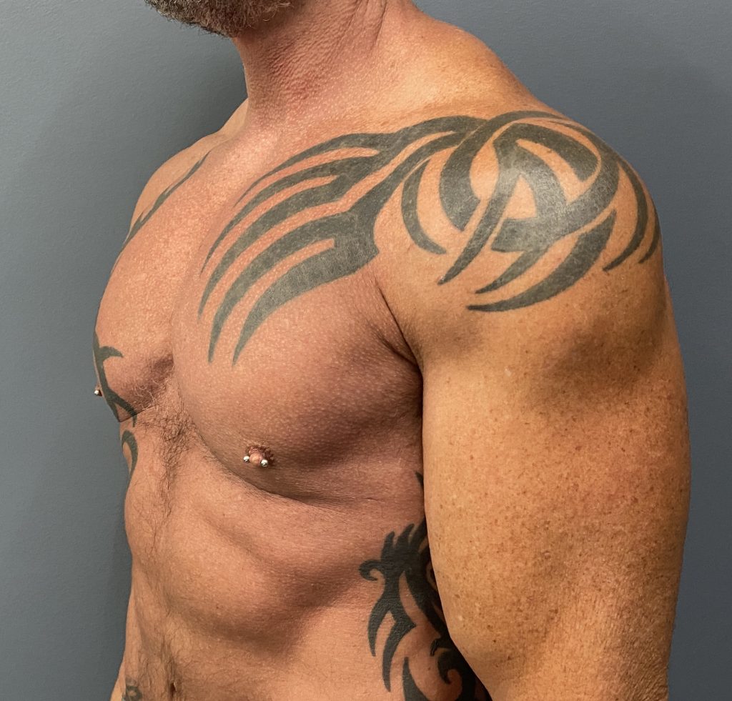 custom pectoral implant replacements left oblique Dr Barry Eppley ...