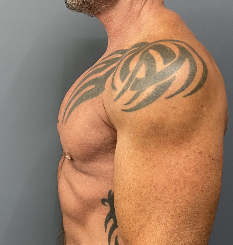 Plastic Surgery Case Study - Custom Pectoral Implant Replacements For ...