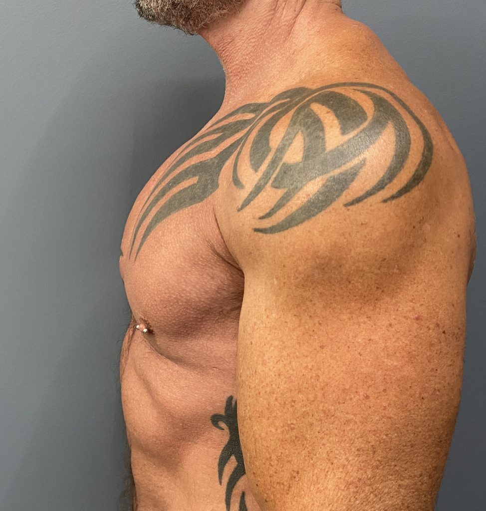 Plastic Surgery Case Study - Custom Pectoral Implant Replacements For ...