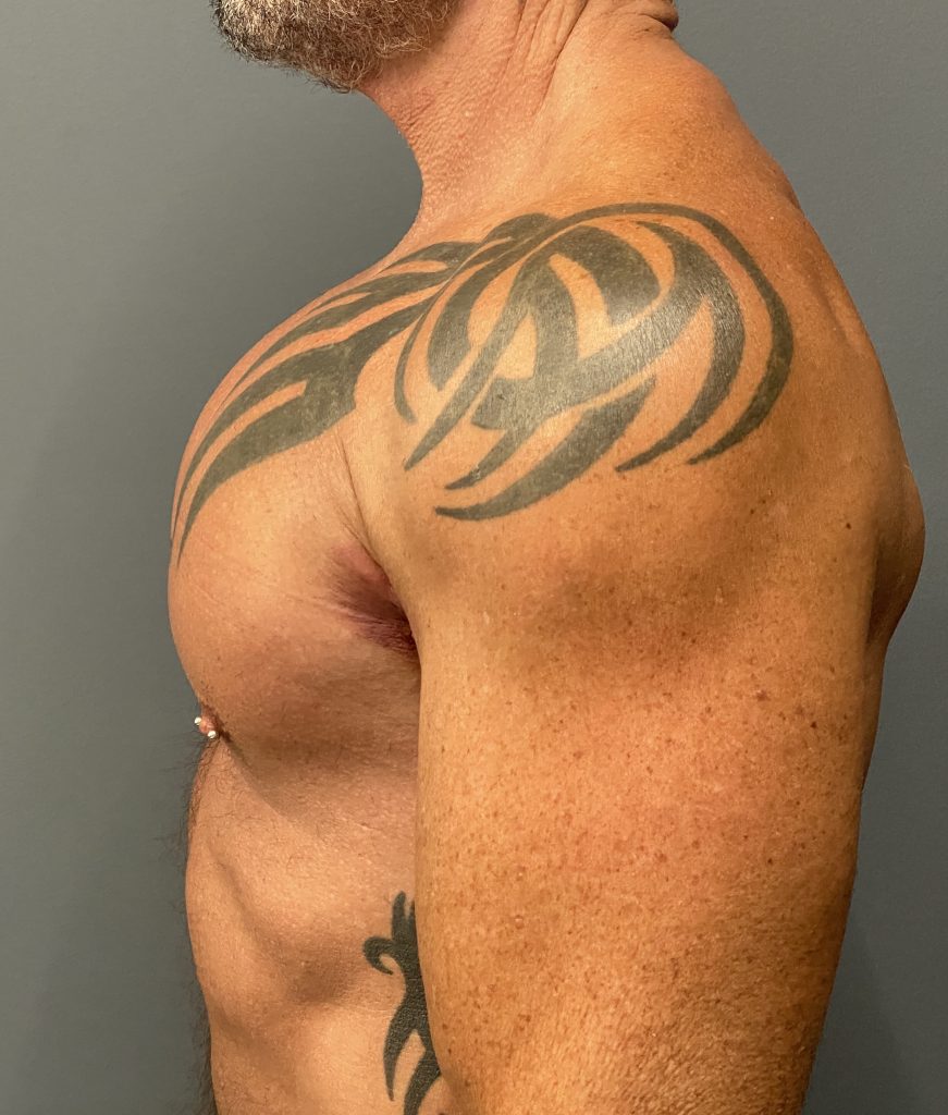 Plastic Surgery Case Study - Custom Pectoral Implant Replacements For ...