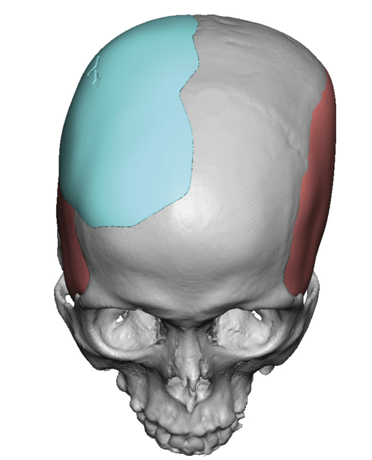 Plastic Surgery Case Study - Correction of Right Lopsided Head Shape ...