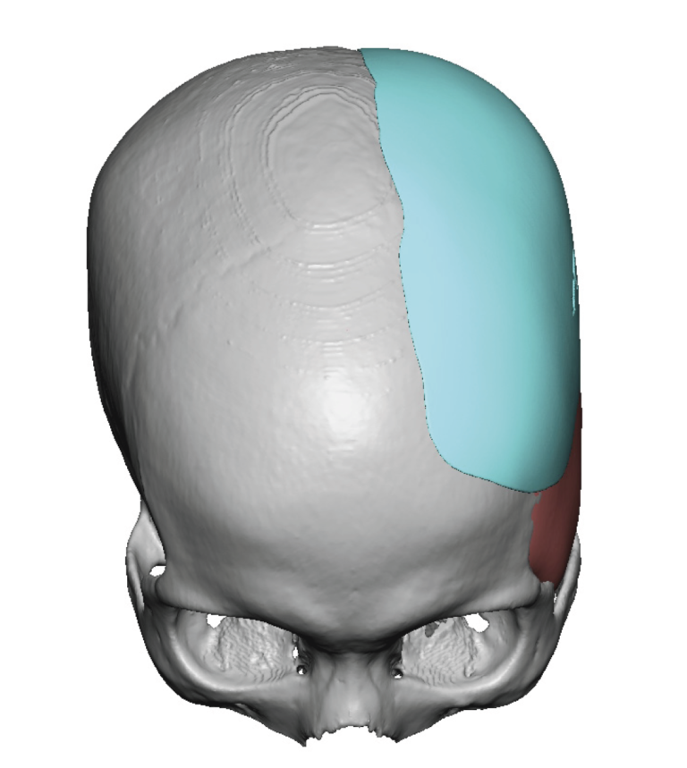 Plastic Surgery Case Study - Custom Skull Implant for Lop Sided Head ...