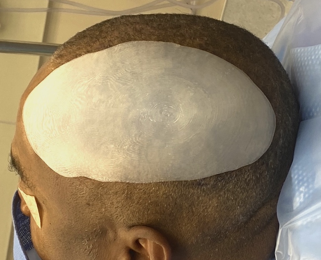 Plastic Surgery Case Study - Custom Skull Implant for Lop Sided Head ...