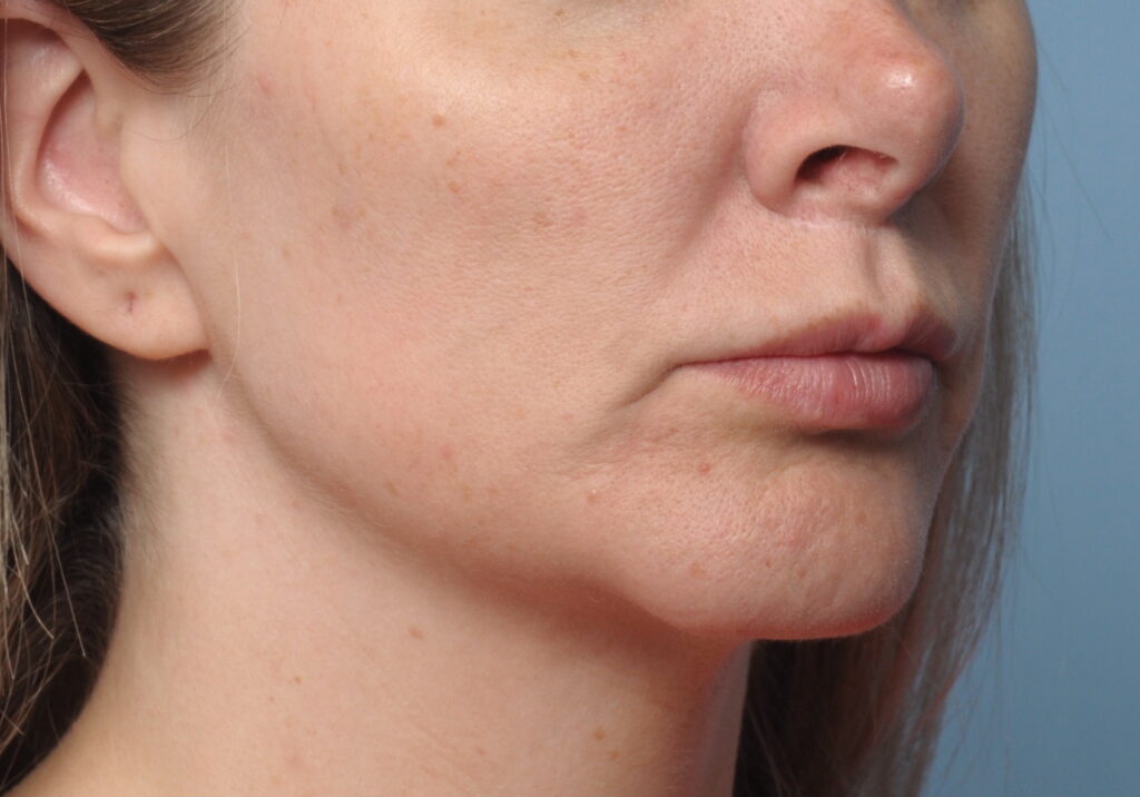 Plastic Surgery Case Study - Custom Female Infraorbital-Malar and ...