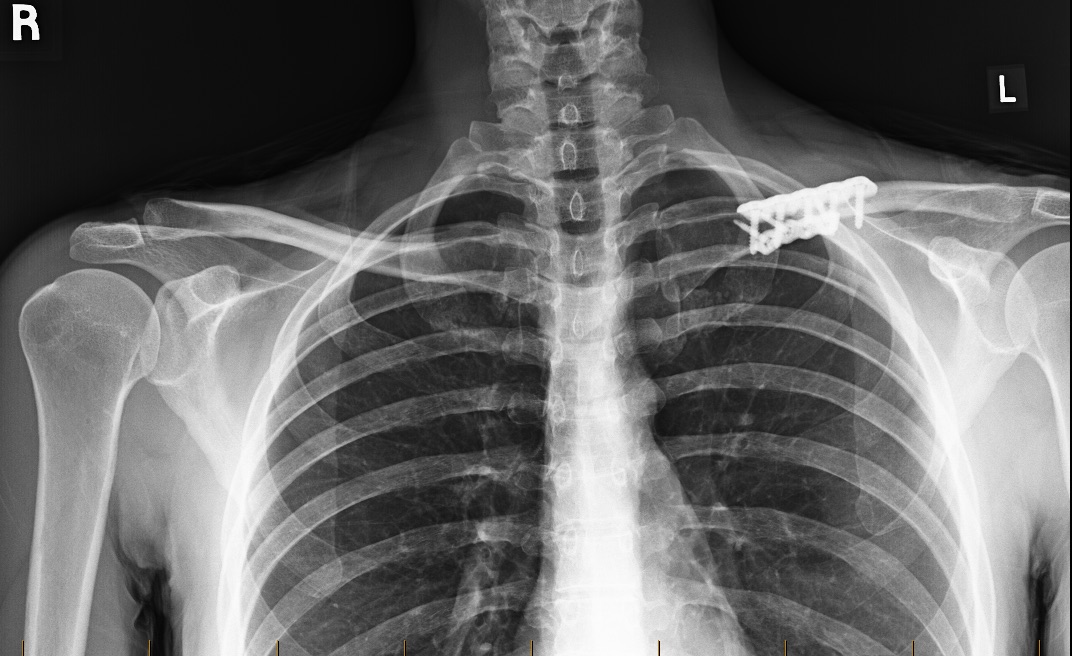 Plastic Surgery Case Study - The Benefits of a Two Stage Approach to ...