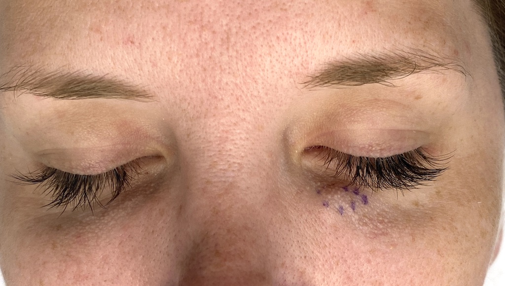 Technical Strategies - Custom Infraorbital Rim Implant Revision ...