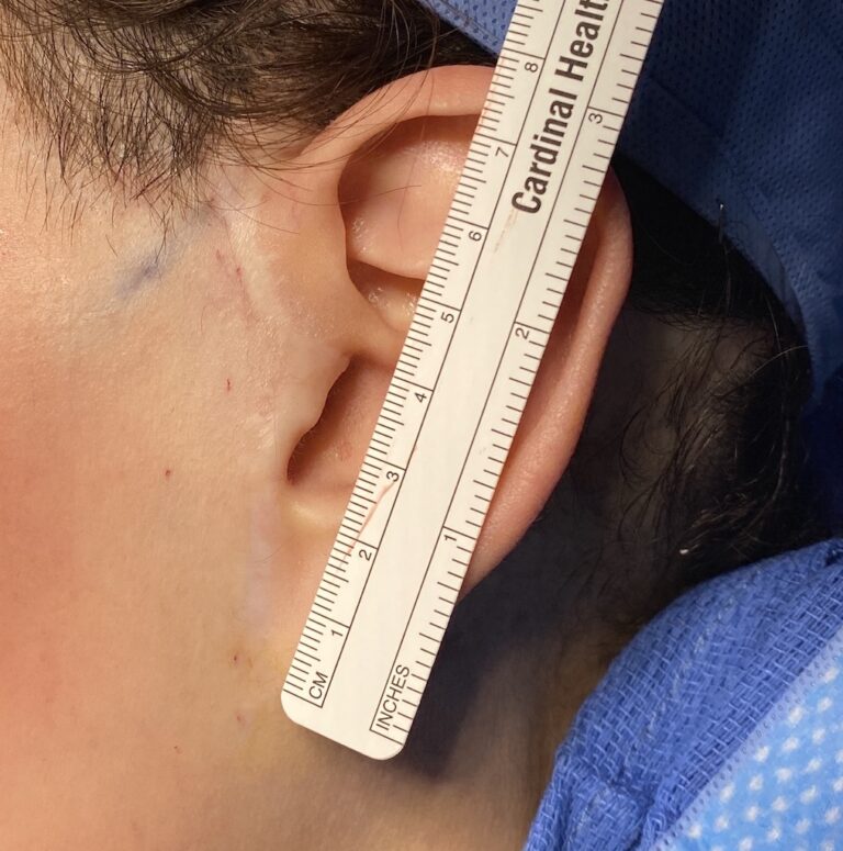 left ear length measurement Dr Barry Eppley - Explore Plastic Surgery
